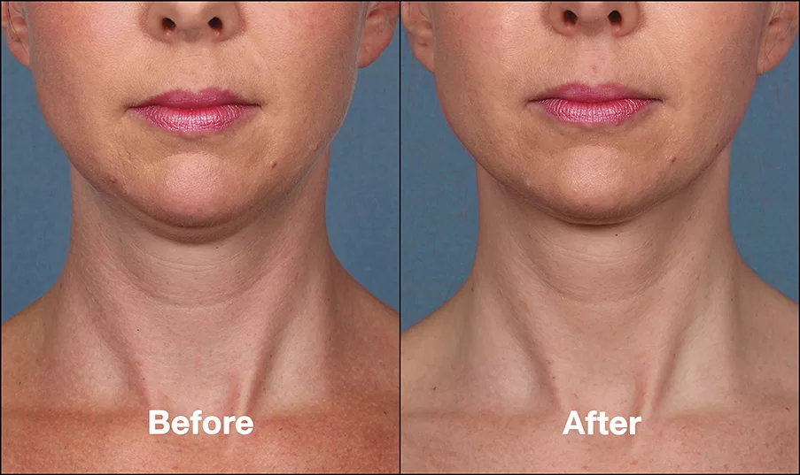 Kybella Minneapolis | MN Cosmetic Dermatologists | Dermatology Specialists