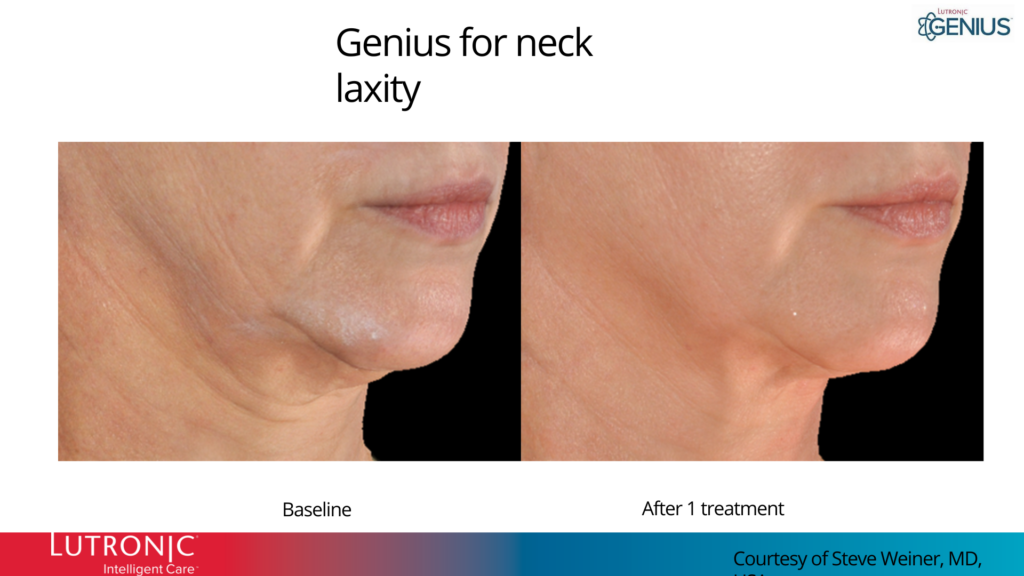 Genius RF Microneedling | Dermatology Specialists